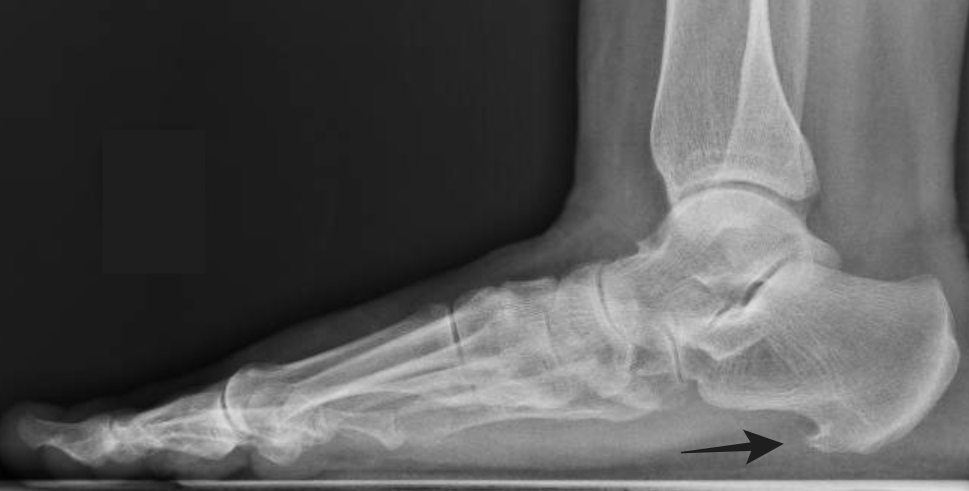 Esporão do Calcâneo: o que é, sintomas e tratamento eficaz